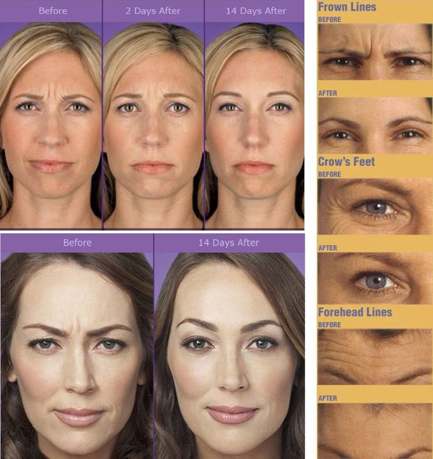 Natural Radiance | Botox North East/Dermal Fillers/Chemical Skin Peels ...